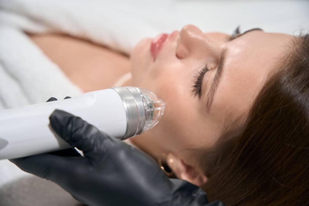 Top 10 Skin Benefits of Dermapen Microneedling You Should Know